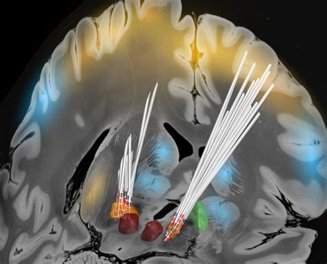 Lead Dbs A Matlab Toolbox Reconstruction And Visualization Of Dbs Electrodes Based On