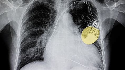 Biventricular Pacemaker Chest X Ray