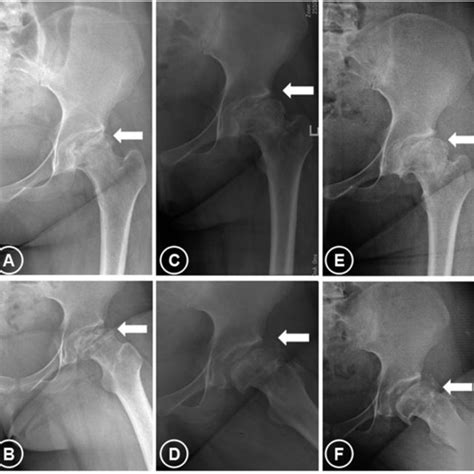 Schematic Diagram Of ‘the Combined Core Decompression Procedure The