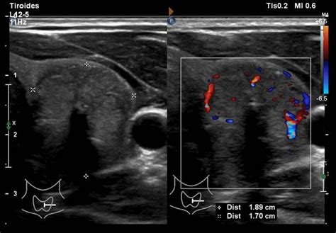 Thyroid Usg Ti Rads 5 Thyroid Nodule With Dimensions Of 1 89 X 1 70 Cm