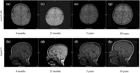 Evolution Of Brain Mri Findings With Age—4 Months 21 Months 5 Years Download Scientific