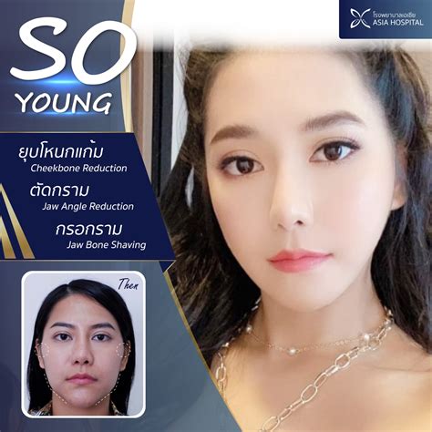 เติมปากเล็กน้อย เสริมจมูก เอเชียคลีนิก หมอทนงศักดิ์