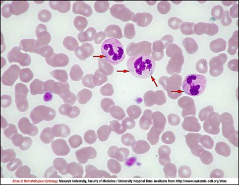 Mayhegglin Anomaly Cell Atlas Of Haematological Cytology