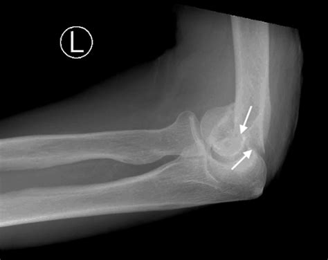 Trochlear Fracture Adult Hand Surgery Resource
