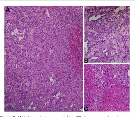 Pdf A Case Of Malignant Glomus Tumor Glomangiosarcoma Of The Nasal