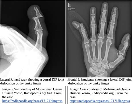 Em 3am Phalanx Dislocation Emdocs