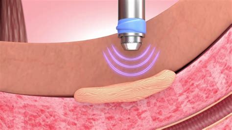 Кривой член или что делать если у парня кривой пенис Youtube