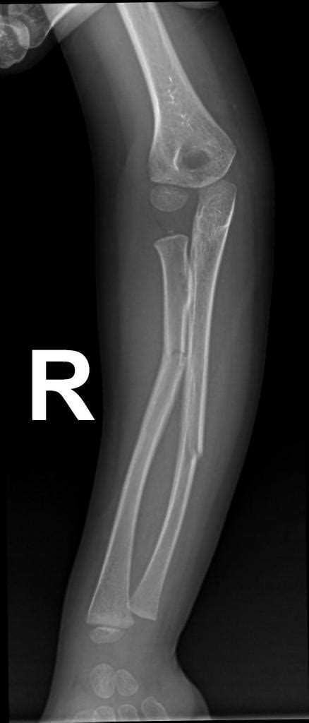 Greenstick Fracture In 2020 With Images Greenstick Fr