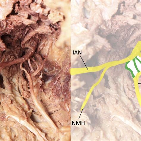 In The Left Infratemporal Fossa There Were Three Communicating Download Scientific Diagram