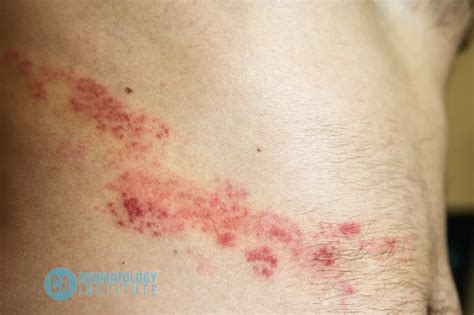 Should I See A Dermatologist For Shingles Ca Dermatology