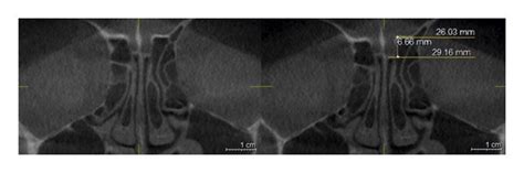 Coronal Plan Of Cbct Demonstrating Type 2 Keros Classification On The