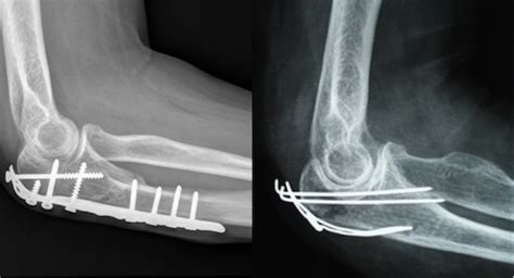 Olecranon Fracture