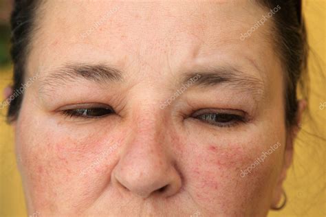 Swollen Face Allergy