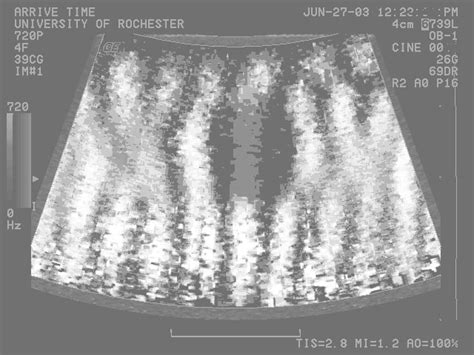 Sonoelastography Image Of Shear Wave Interference Pattern On A Zerdine Download Scientific