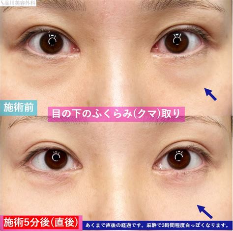 クマ取りの症例術前、直後 品川スキンクリニック院長長谷部のブログ