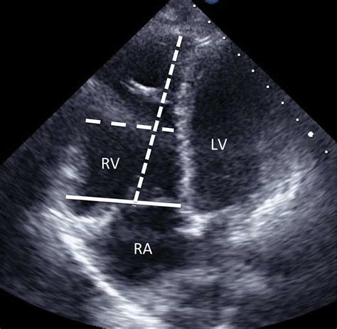 Right Heart Failure Understanding The Hemodynamics Part 1 Preload