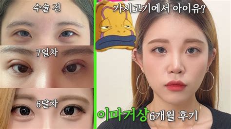 34만 조회수 20대 이마거상💕 6개월 후기 이마거상 앞트임 눈매교정 Youtube