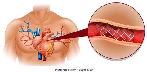 Heart Disease Diagram Human Illustration Stock Vector Royalty Free Shutterstock