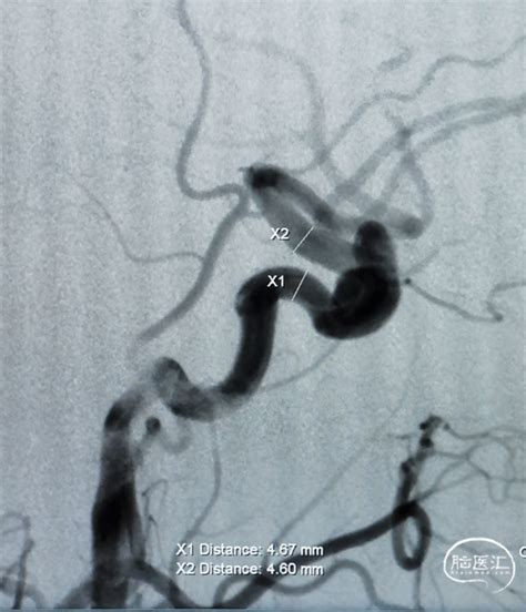 Lattice Time｜可完全回收到保护鞘的lattice助力上海冬雷脑科医院治疗复杂迂曲血管段动脉瘤 脑医汇