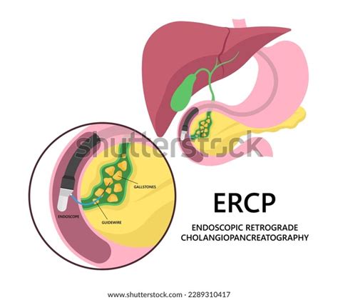 Choledocholithiasis Endoscopic Retrograde Cholangiopancreatography Ercp Common Stock Vector