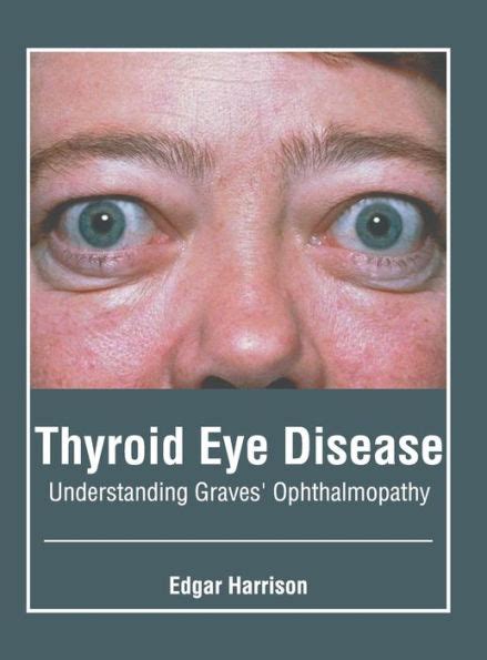 Thyroid Eye Disease Understanding Graves Ophthalmopathy By Edgar