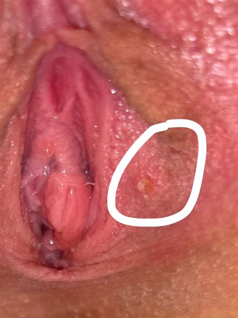 What Is This Bump R Obgyn