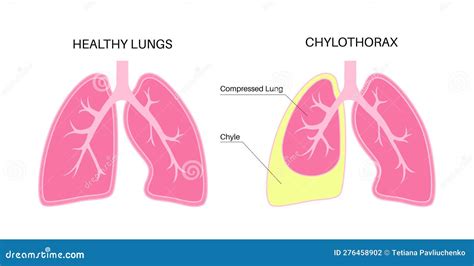 Chylothorax Anatomical Poster Cartoon Vector 276540719