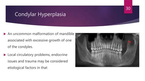 Developmental Defects Of Oral And Maxillofacial Region Pptx Dental