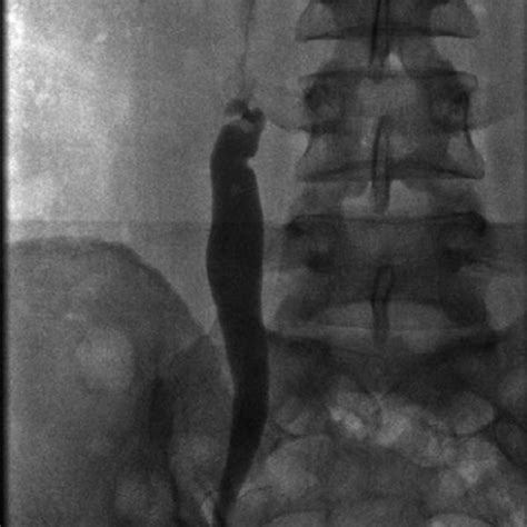 Retrograde Pyelogram Demonstrating No Extravasation Of Contrast 6