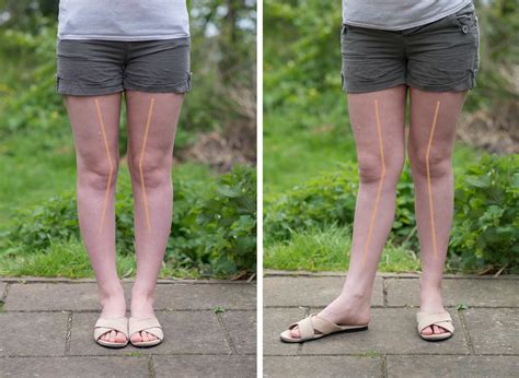 10 Hypermobile Ehlers Danlos Syndrome Life Hacks Raindrops Of Sap