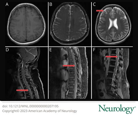 Primary Diffuse Leptomeningeal Neurology Journal