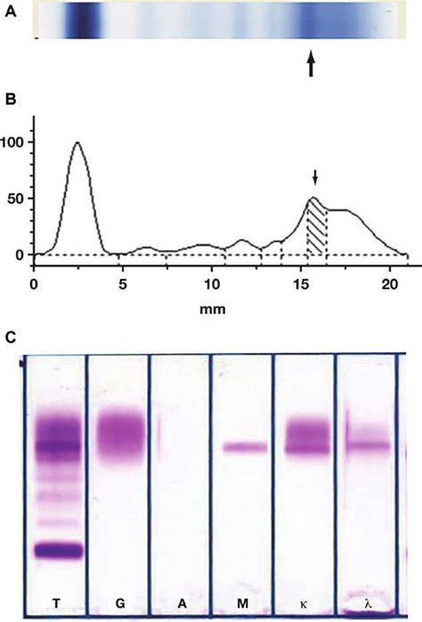 Double Gammopathic Manifestations With Immunoglobulin Ig M Download Scientific Diagram