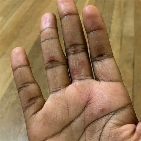 Dusky Skin Color Medical