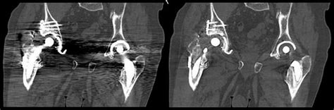 Mar Eller Metal Artifact Reduction