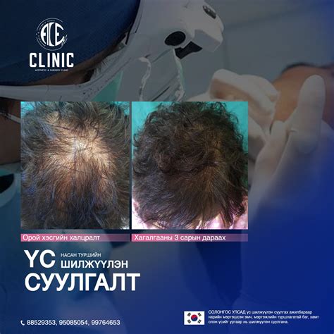 Ace НАСАН ТУРШИД УРГАХ ҮС ШИЛЖҮҮЛЭН СУУЛГАЛТ 👨 Уртаар нь суулгана