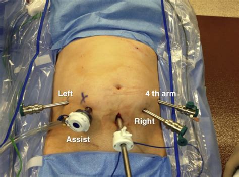 Robot Assisted Laparoscopic Retroperitoneal Lymph Node Dissection For Testicular Cancer