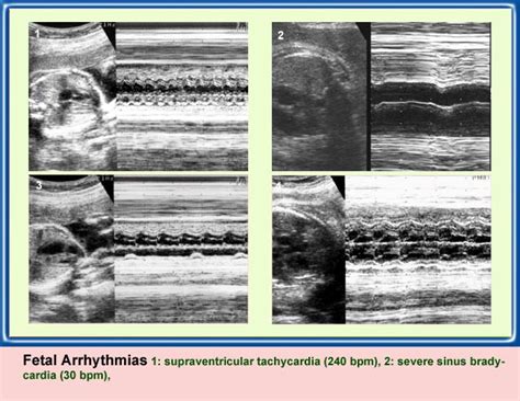 Fetal Arrhythmias Department Of Obstetrics And Gynecology Faculty Of