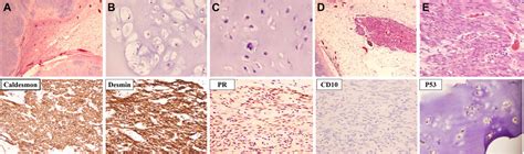 Por A Case Report Of Recurrent Leiomyosarcoma With Chondrosarcoma Differentiation In The