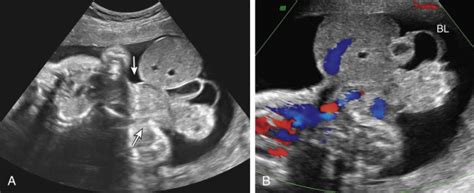 Limbbody Wall Complex Radiology Key