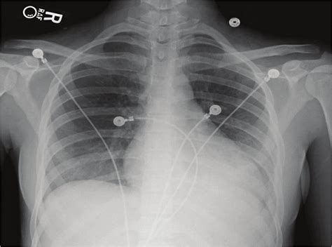 Chest X Ray Showing Hazy Bibasilar Opacities Suggestive Of Atelectasis Download Scientific