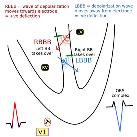 Understanding Bundle Branch Blocks