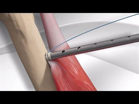 Biceps Tenodesis With Bicepsbutton™ Kit Youtube