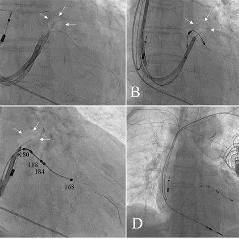 Prior Contrast Venography Of The Left Subclavian Vein The Contrast Download Scientific Diagram