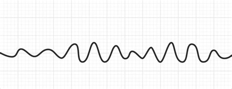 Ventricular Fibrillation Tachyarrhythmias Medschool