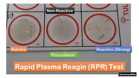 Rapid Plasma Reagin RPR Test Introduction Principle Procedure Resu