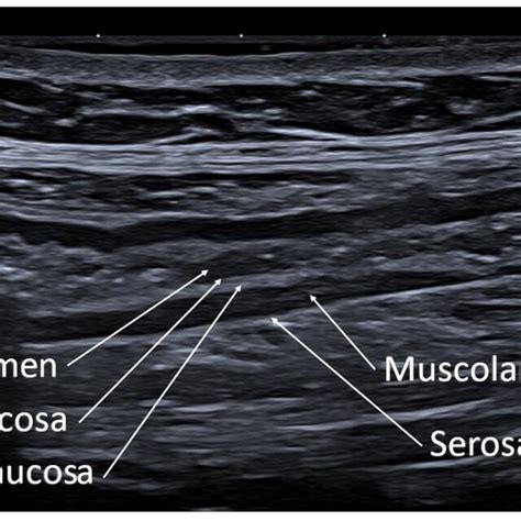 Image Obtained With A High Frequency Linear Probe Longitudinal Scan On Download Scientific