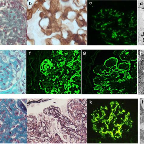 Pdf Acquired And Genetic Complement Abnormalities Play A Critical
