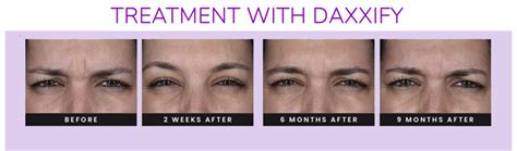 Daxxify New Long Lasting Alternative To Botox Forley Plastic Surgery Blog