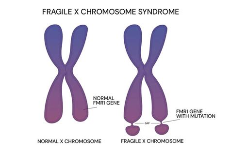 Fragile X Chromosome Syndrome And Its Relationship With Infertility