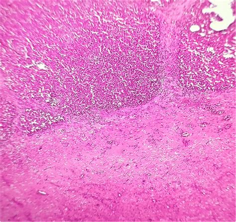 Histological Section Of Fibrinous Bronchopneumonia Characterized By